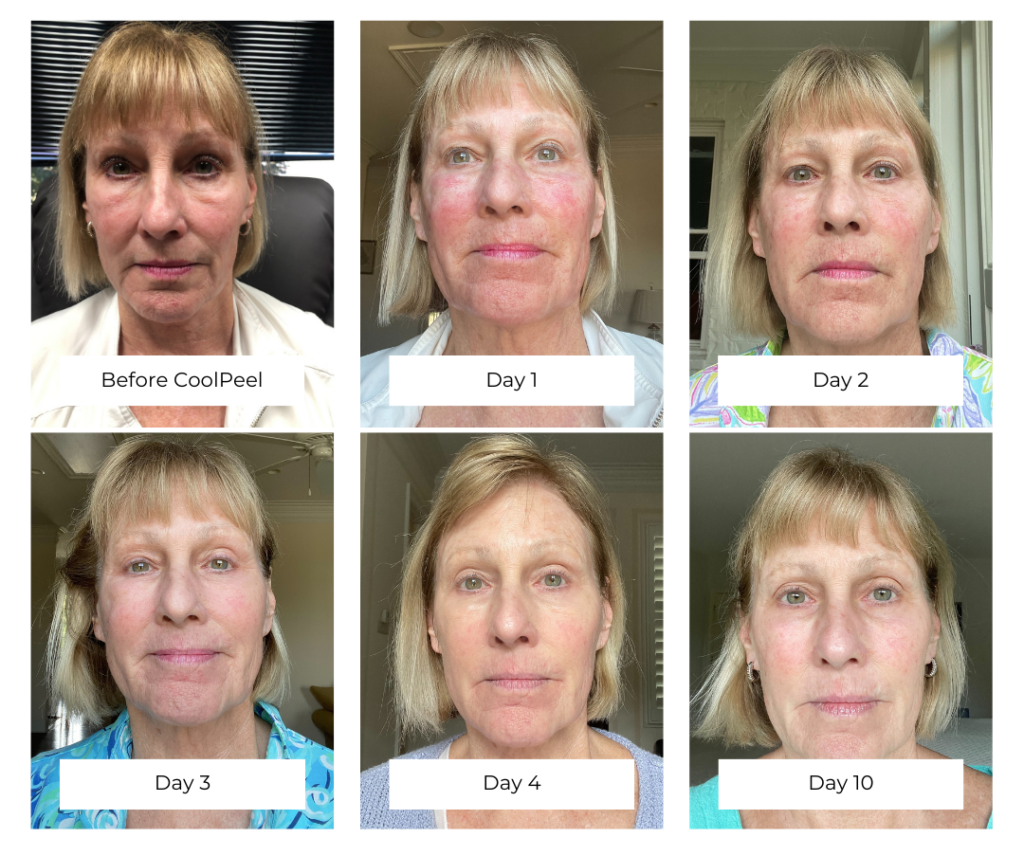 Explore CoolPeel Treatment | Carolina Hormone & Health